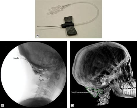 Lesser Occipital Nerve Blocks Coding