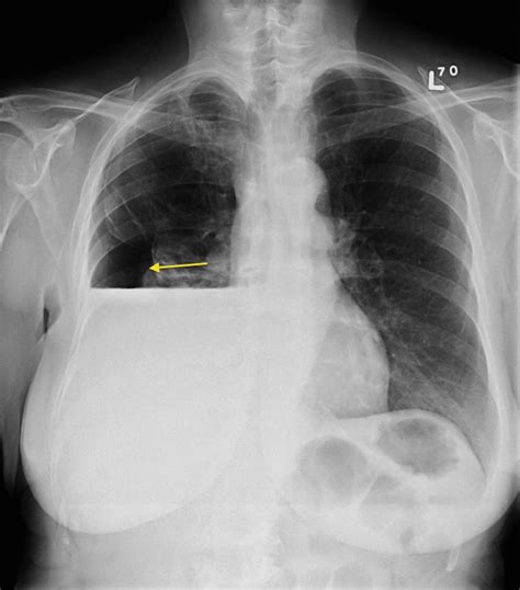 Hydropneumothorax Radiology At St Vincents University Hospital