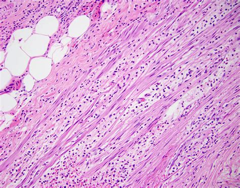 Pathology Outlines Acute Appendicitis