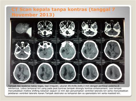 Ct Scan Kepala Dengan Kontras Ct Scan Machine My XXX Hot Girl