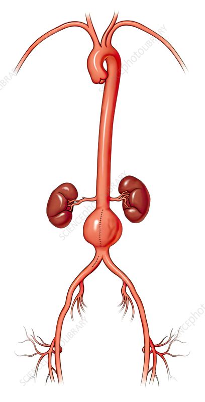 Abdominal Aortic Aneurysm Illustration Stock Image C0593316