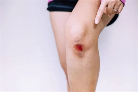 Knees Bleeding Stock Images Search Stock Images On Everypixel