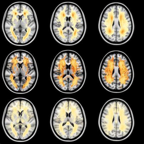 The Mni 152 Standard Brain Template 30 Showing Different Overlays Download Scientific