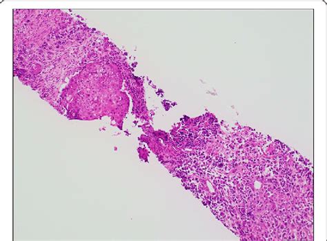 A Microscopic Image Of Repeated Prostatic Needle Biopsy Hematoxylin Download Scientific