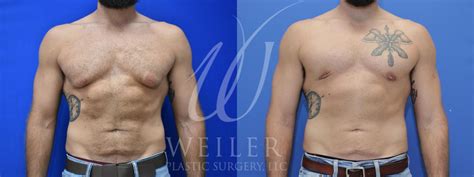 Breast Reduction Tattoos Breast Reduction Tattoo Cover Up