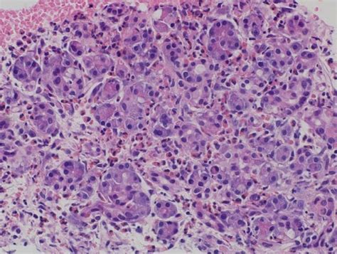 Marked Infiltration Of Eosinophils Is Seen In The Edematous