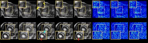 fixed anatomy varying sampling pattern and acceleration factors left