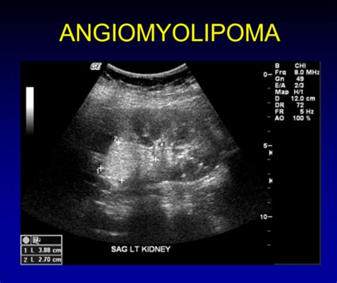 Nephrouro Radiology Flashcards Quizlet