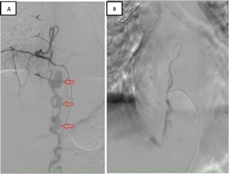A Dsa Before Embolization Dilated Posterior Lateral Spinal Veins