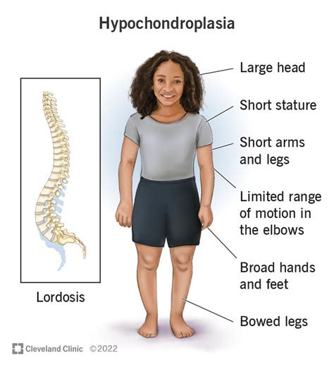 Achondroplasia Symptoms And Characteristics