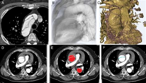 Three Dimensional 3d Reconstruction Of The Aortic Dissection