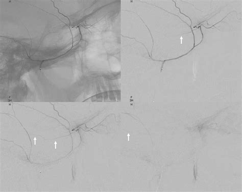 Ophthalmic Artery
