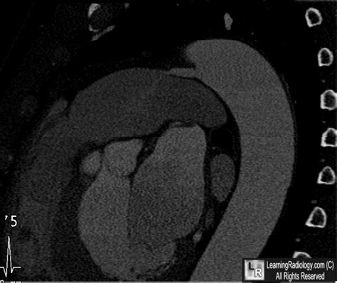 LearningRadiology Patent Ductus Arteriosus Pda Left Right Shunt Arteriosous Radiology