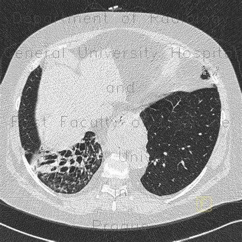 Radiology Case Bronchiectasia Hrct