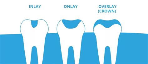 Inlays And Onlays For More Conservative Treatment Approach