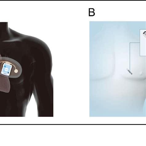 Typical Examples Of Each Ecg Device A Patch Type Ecg Ememo