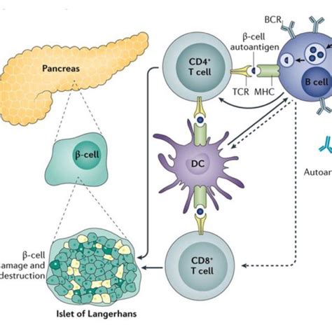 Pancreatic Inflammation And Insulitis In T1d Katsarou Et Al 2017