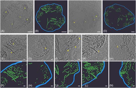 Intraneuronal Aβ Accumulation Causes Tau Hyperphosphorylation Via Endolysosomal Leakage Pmc