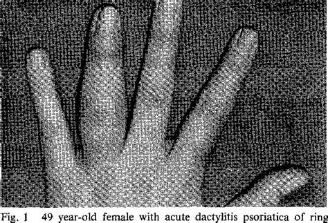 Figure 1 From Differential Diagnosis Of Acute Dactylitis Psoriatica Semantic Scholar