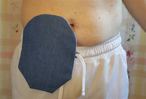 Sex With An Ostomy Tips For Better Intimacy W Video Veganostomy