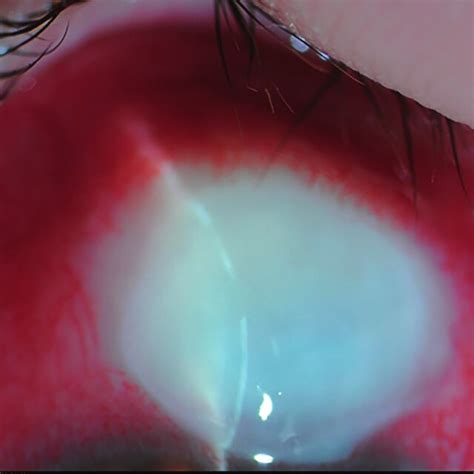 White On Red Appearance Of Bleb Related Infection Notice Adjacent