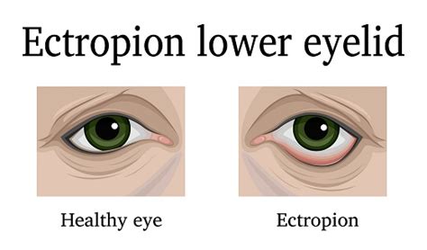 Ectropion Causes Symptoms And Complications
