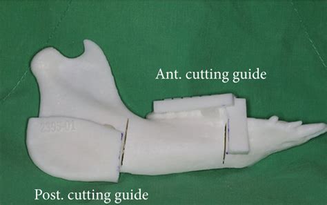 A Individualized Templates For Osteotomy B Light Cured 3d Printed Download Scientific