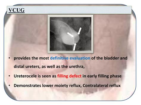 Ureterocele Pptx