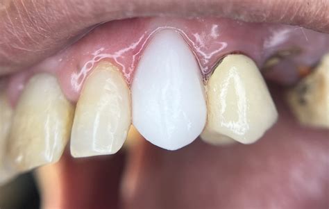 Using Flap Technique Crown Lengthening Has Been Done And Building Up