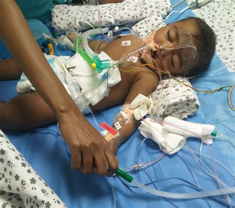 Dengue Shock Syndrome