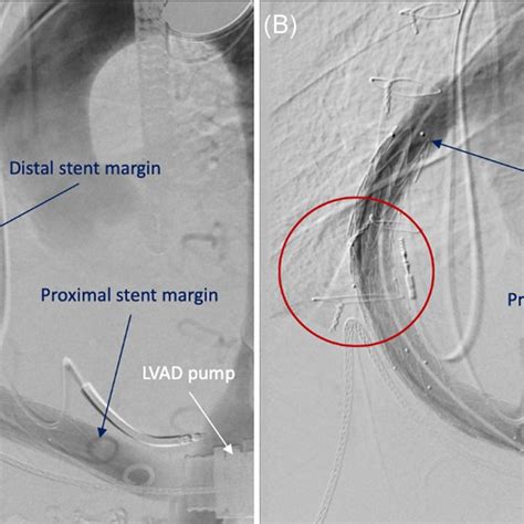 Endovascular Access Of Lvad Outflow Graft Before A And After B