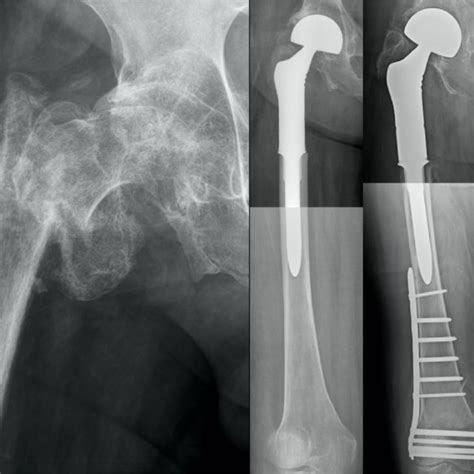 Judet Letournel Classification Of Acetabular Fractures Into Five Download Scientific Diagram