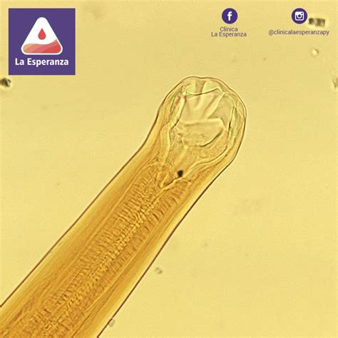 ¿qué Es La Anquilostomiasis Y Qué Clínica La Esperanza