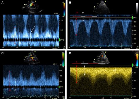How Should Echocardiography Be Used In Crt Optimization Thoracic Key