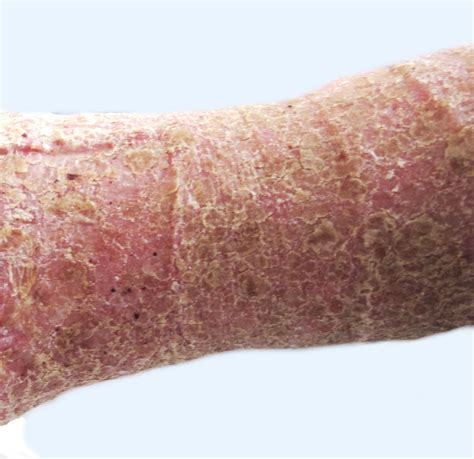 Xerosis Cutis