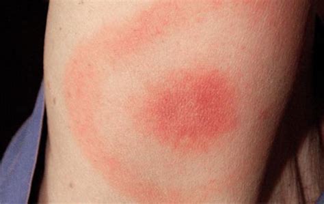Lyme Disease Rash Causes Symptoms Diagnosis And Treatment