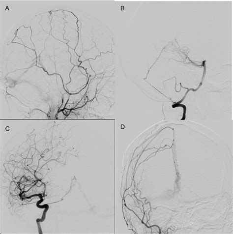 Transvenous Embolization Of Dural Arteriovenous Fistulas With Cortical