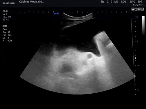 Ascite Carcinologique Societe Nationale Déchographie En Médecine