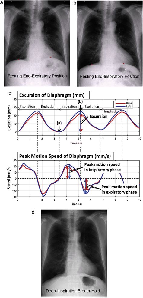 Representative Sequential Chest Radiographs And The Graphs Of Excursion