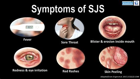 Stevens Johnson Syndrome Signs