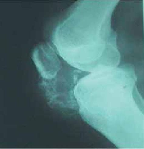A Case 4 Lateral X Ray Of The Right Knee Showing Infrapatellar