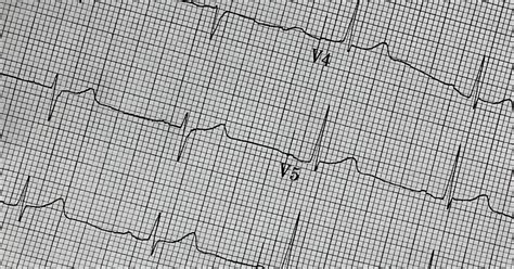 Common Causes Of Qrs Complex What You Need To Know