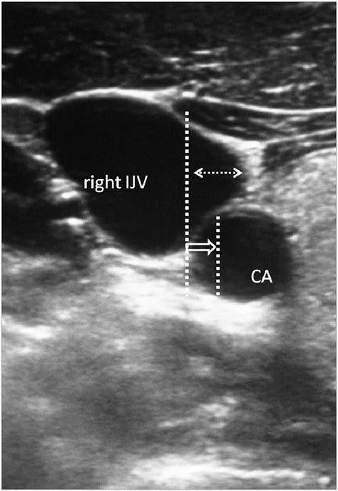 Ultrasound Image Of The Right Ijv And Relationship With Ca Interrupted