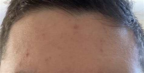 How To Manage My Hyperpigmentation Redness And Persistent Acne Rausskincare