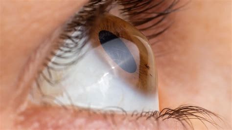 Keratoconus Screening Epithelial Mapping And Expert Analysis