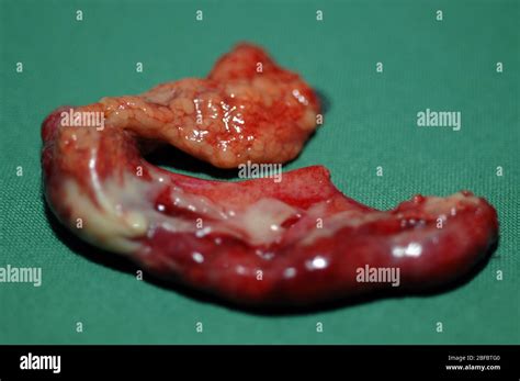 The Excised Appendix It Is Larger Than It Would Appear In A Normal