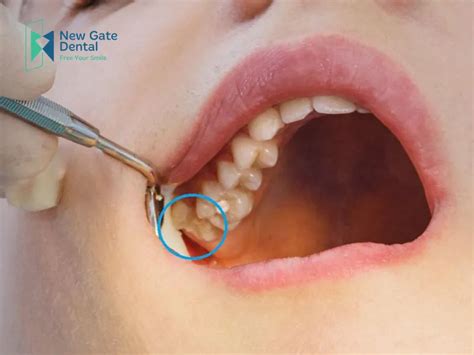 Impacted Upper Wisdom Teeth Causes And Symptoms