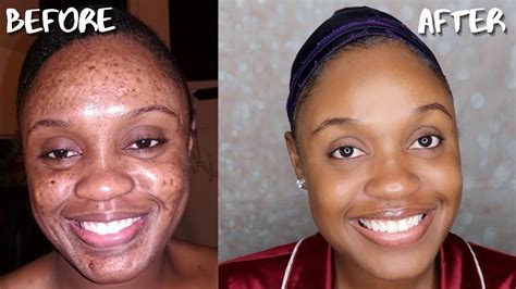 Body Hyperpigmentation Before And After At Adelina Simmons Blog