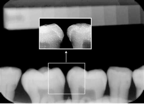 Figure 1 From Approximal Caries Depth Assessment With Storage Phosphor Versus Film Radiography