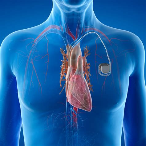 Insertion Of A Pacemaker Or Defibrillator Device Monash Heart Private